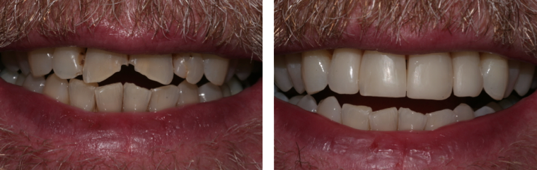 Bioclear Dental Treatment by Smile Concepts, Solihull